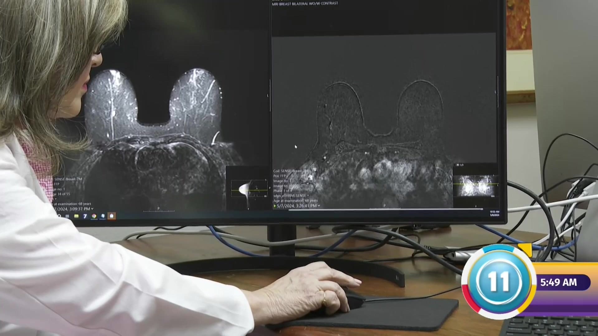 Tecnología permite realizar biopsias de seno más precisas - TeleOnce TV ...