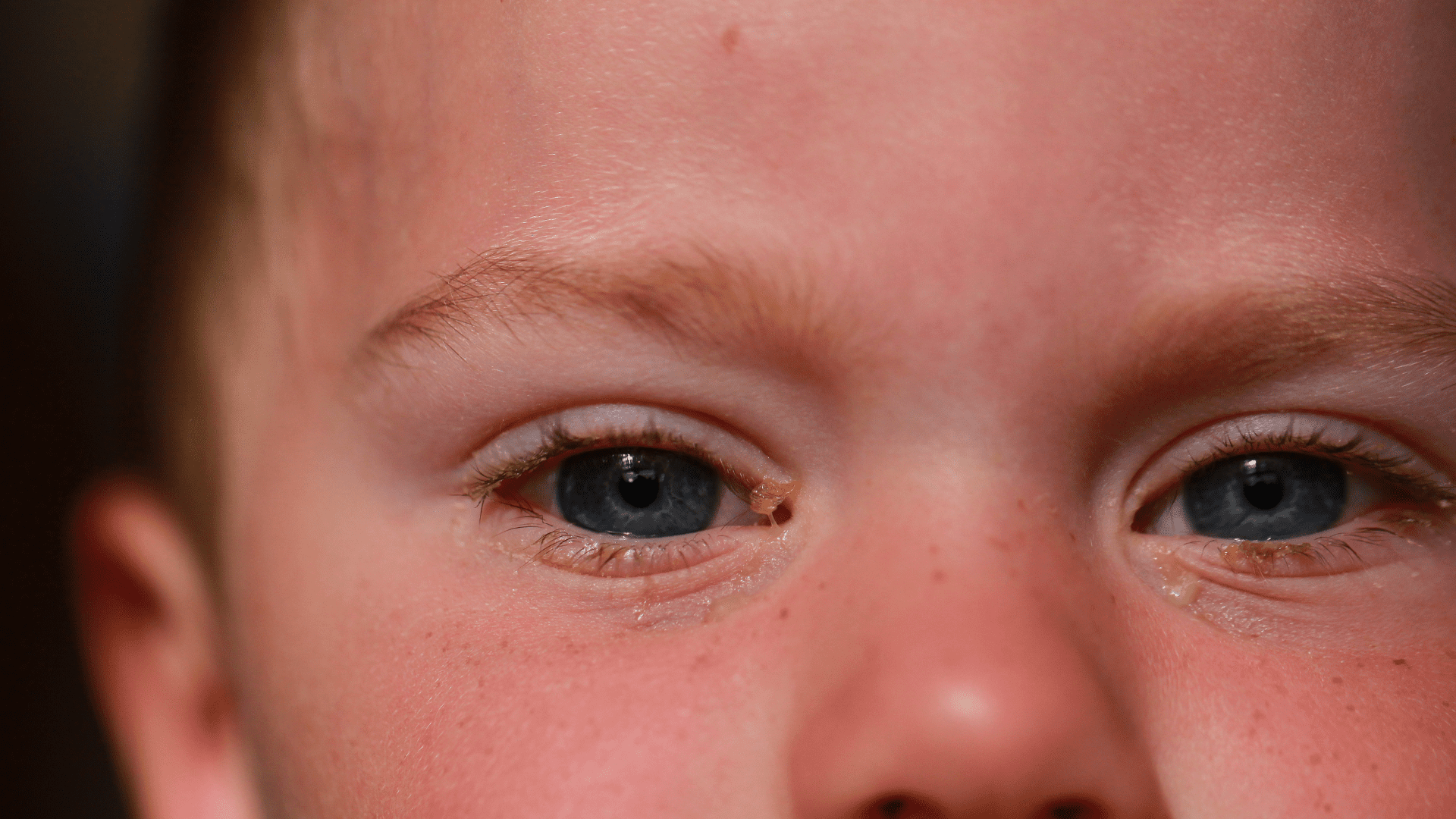 Aumento de casos de conjuntivitis en los niños - TeleOnce TV | Vívelo